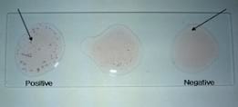Positive Agglutination Test