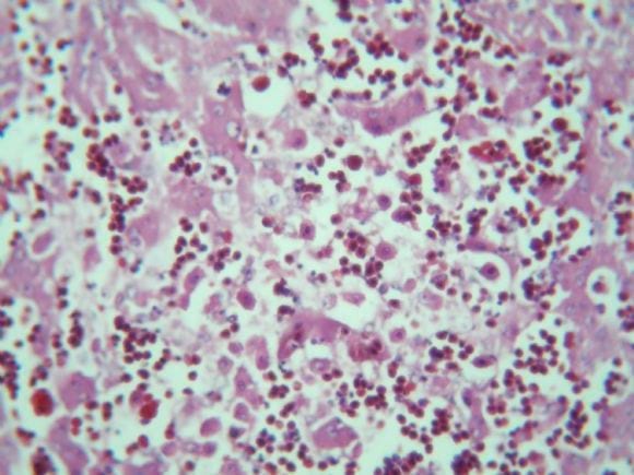 HISTOMONIASIS. Ref: 9176